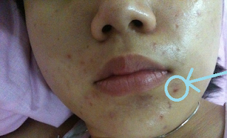 Miniature Agnes: Acne Products